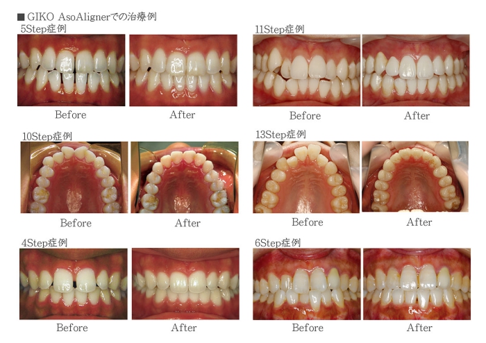 GIKO_asoaligner_japanese_dent of labogiko-w
